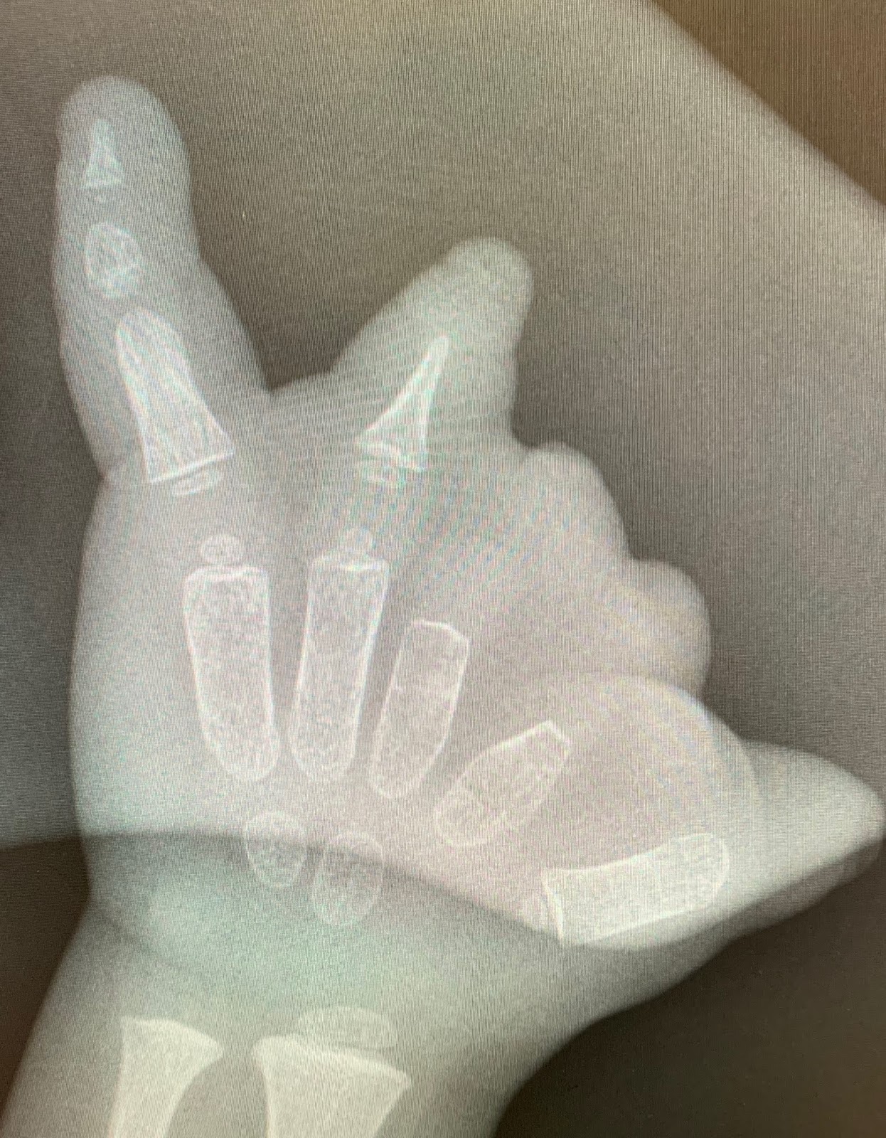 Amniotic Constriction Band- how we can help function | Congenital Hand ...