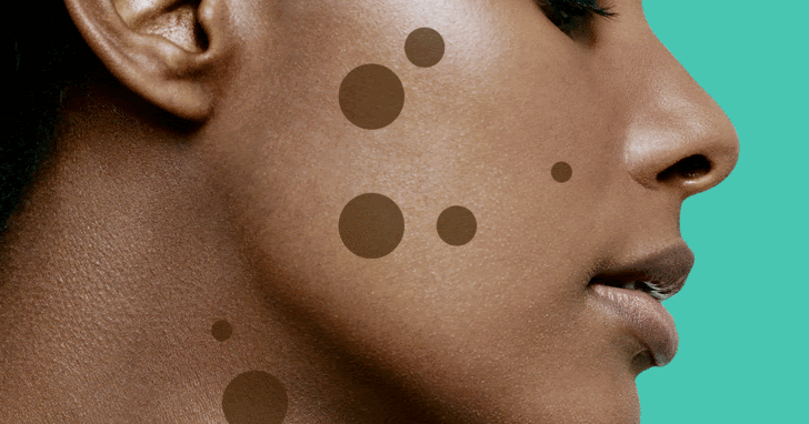 Feeling Spotty? (LOL) Hyperpigmentation...
