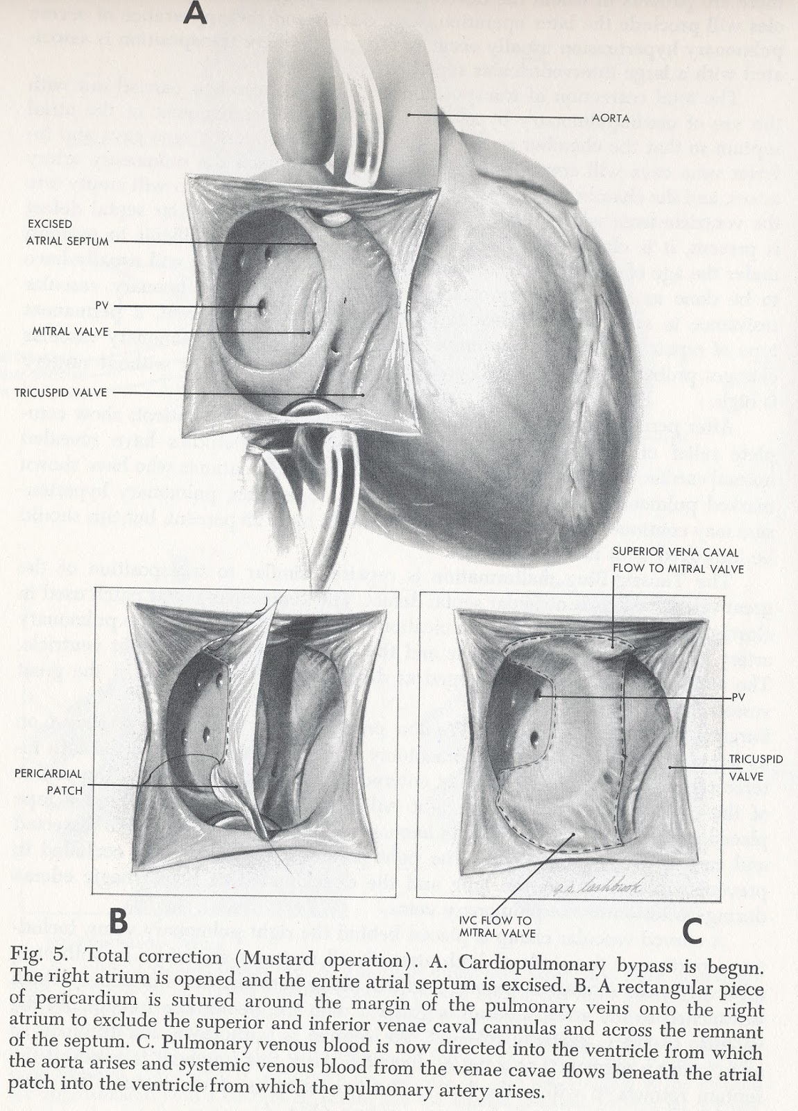 Pedi cardiology: Mustard Operation for d-Transposition of Great Arteries
