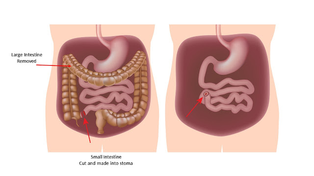 No More UC for Me: J-Pouch Surgery 101