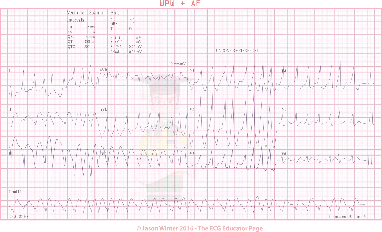 ECG Educator Blog : Wolff-Parkinson-White