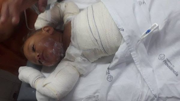 Bebê queimada por irmão passa por cirurgia neste sábado
