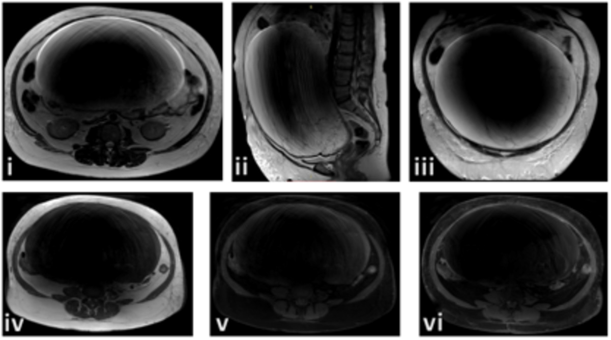 Radiology Community: Dielectric shading artifacts in high field ...