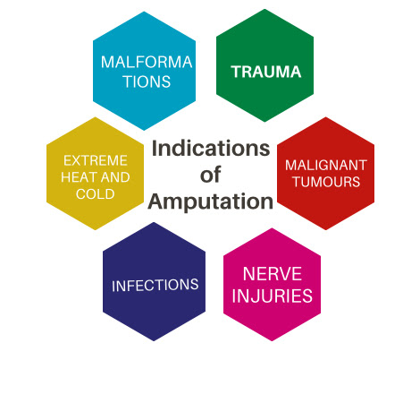 All about physiotherapy: Amputation (Causes, level) along with its ...