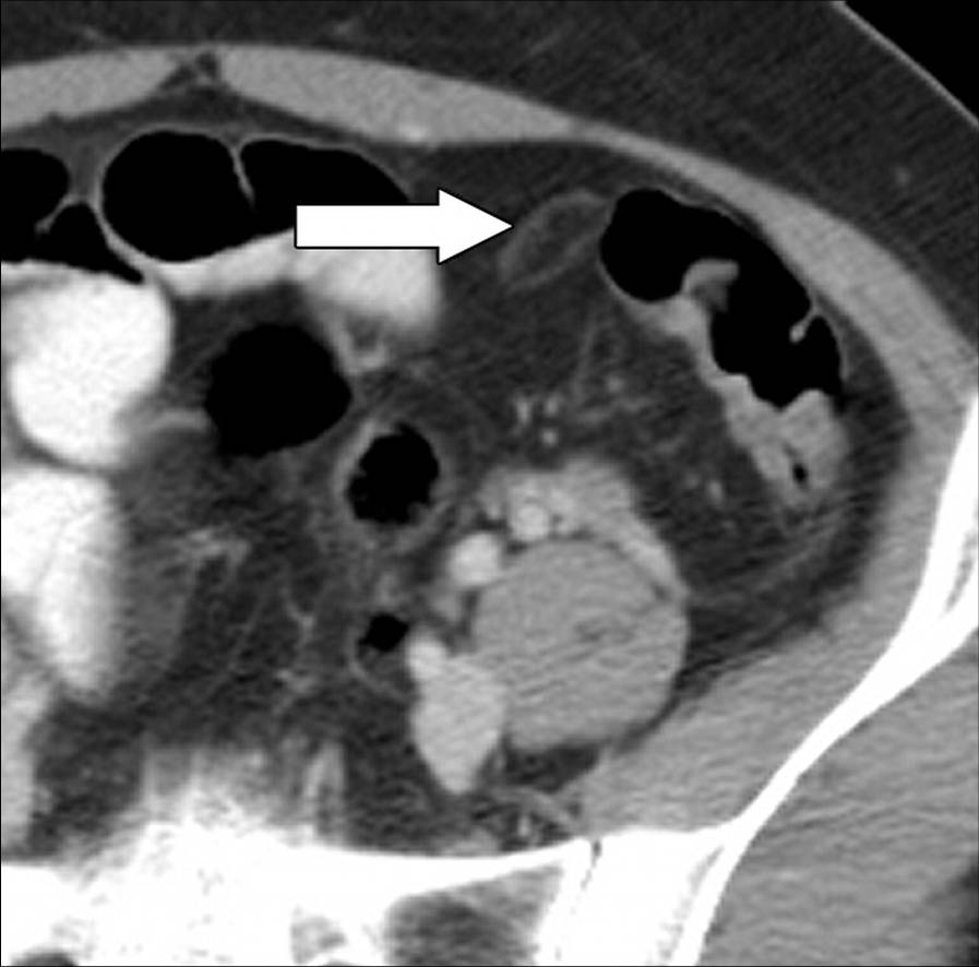 ABC Radiology Blog: The Ring Sign