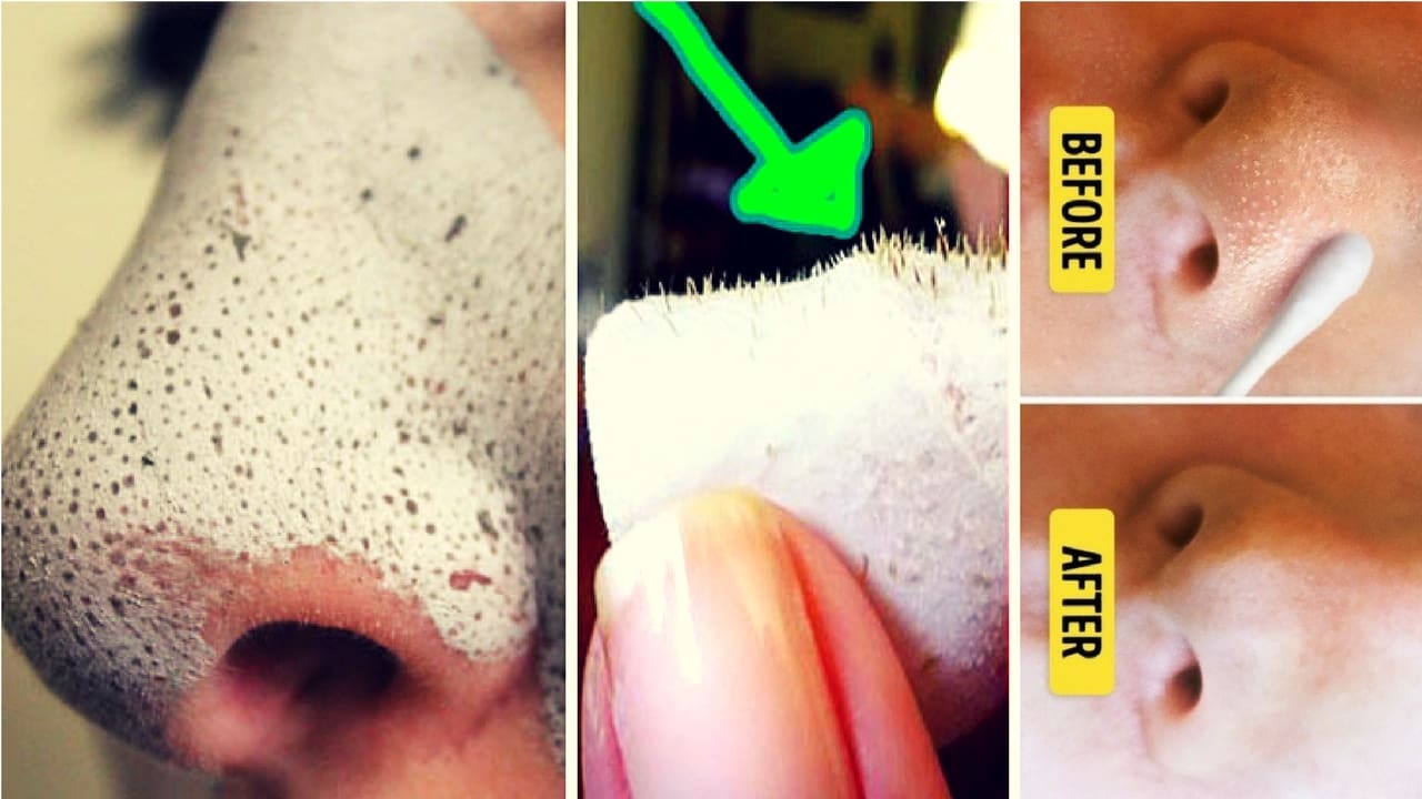 How To Get Rid Of Blackheads And Whiteheads Overnight how-to-get-rid-of-blackheads-and-whiteheads-overnight