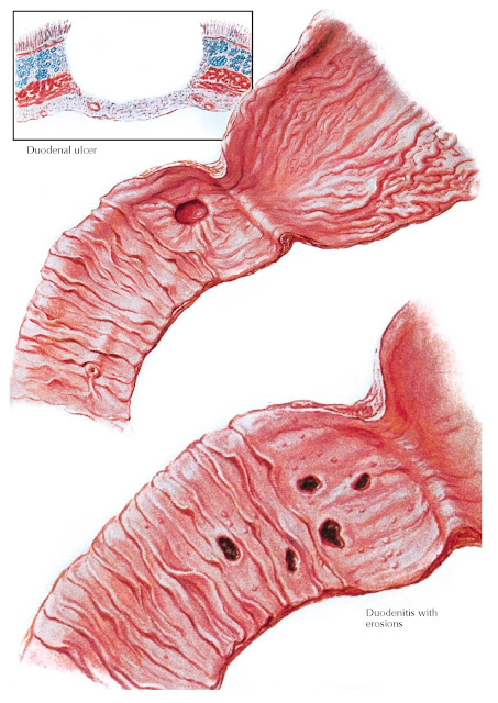 PEPTIC ULCER: DUODENITIS AND ULCER OF DUODENAL BULB - pediagenosis