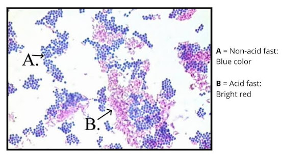 Acid-Fast Staining : Principle, Procedure, Interpretation and Examples.