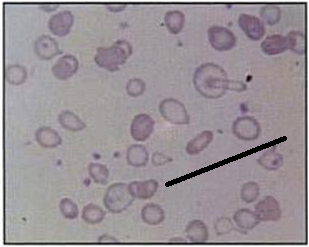 Células sanguíneas: Anormalidades eritrocitarias ANEMIAS