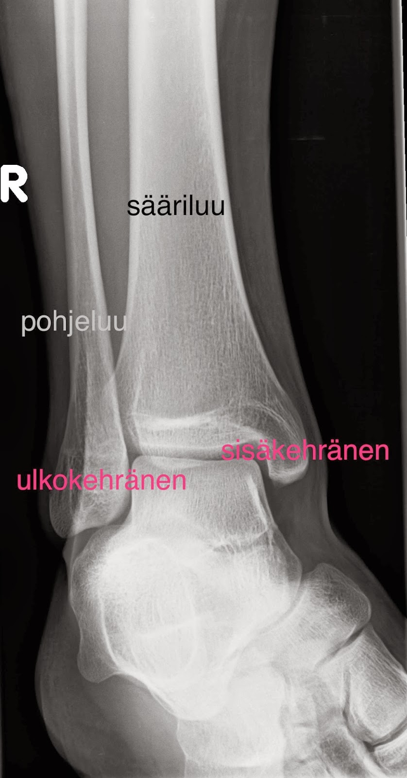 Elämyskameli: 16: nilkan natiiviröntgenkuva