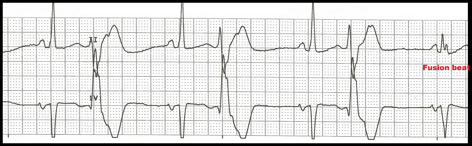 Practice EKG Rhythm Strips 175