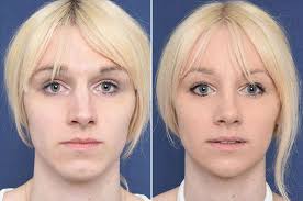 Facial Feminization | Beautiful Transgenders