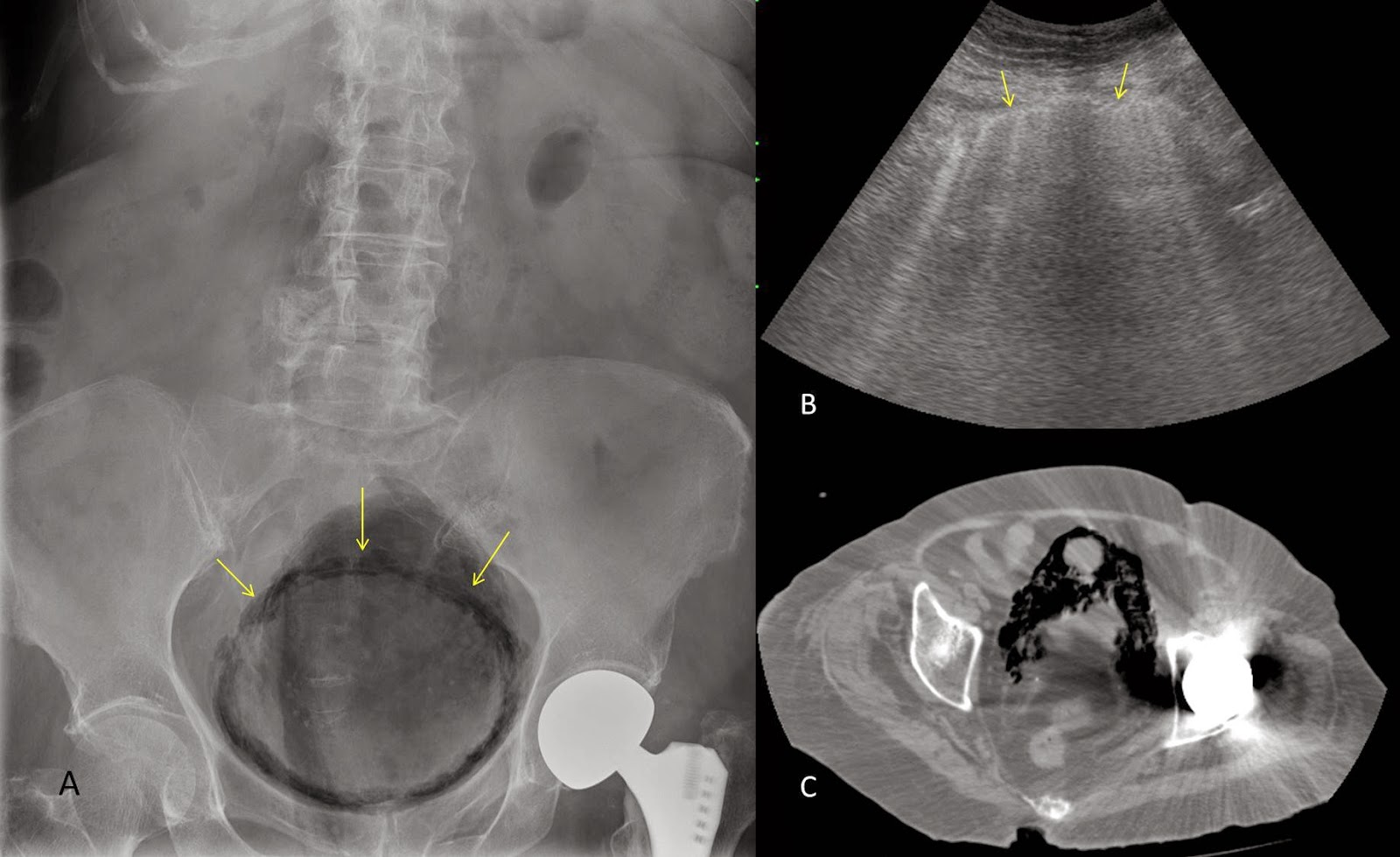 Cistitis Enfisematosa: Cistitis Enfisematosa