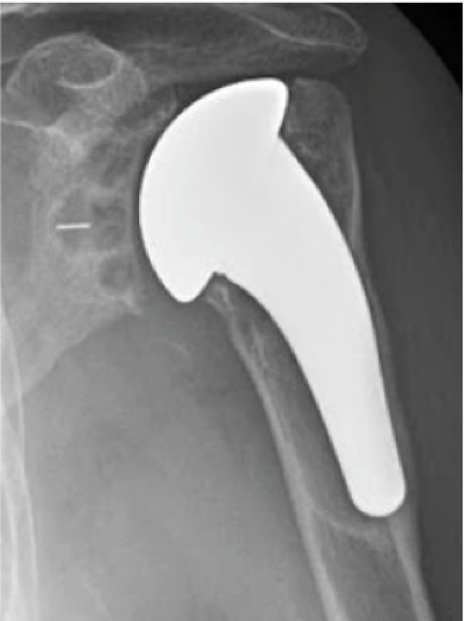 UW Shoulder and Elbow Academy: Short stemmed humeral implants - what we ...