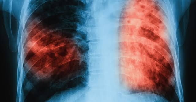 ASUHAN KEPERAWATAN PADA PASIEN TUBERCULOSIS (TB) PARU DI RUANG PENYAKIT ...