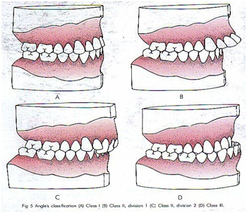 Ilmu Kedokteran Gigi: Maloklusi dan Pertumbuhan serta Perkembangan ...