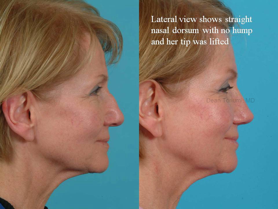 Dr. Dean Toriumi Reviews: Dean Toriumi Reviews: Patient presented with ...