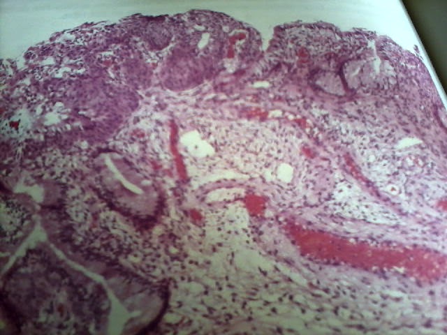 Agustina Ocampo - Patología B 2014: Cervicitis aguda y crónica