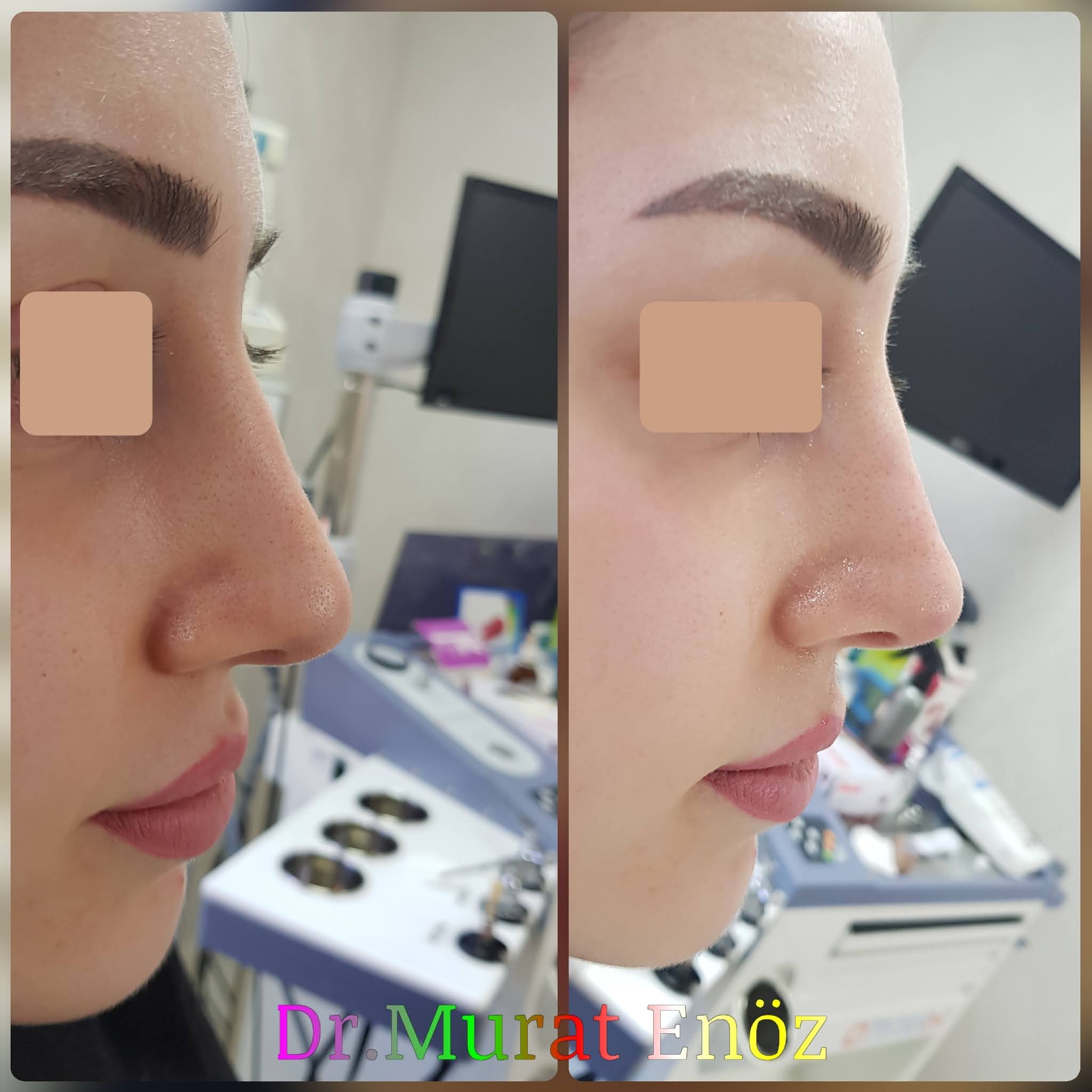 Liquid Rhinoplasty With Limited Filler Injection