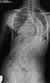 Halo-Gravity Traction in Spinal Deformity Treatment (Part 3) | Growing ...