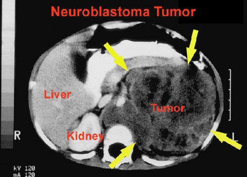 TECNICAS DE PEDIATRIA: NEUROBLASTOMA