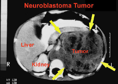 TECNICAS DE PEDIATRIA: NEUROBLASTOMA