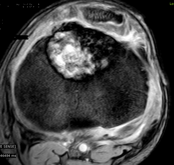 Chondroblastoma-MRI - Sumer's Radiology Blog