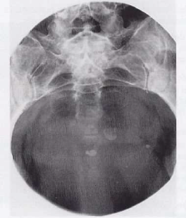 SACRO-COCCIX Y ARTICULACIONES SACROILIACAS