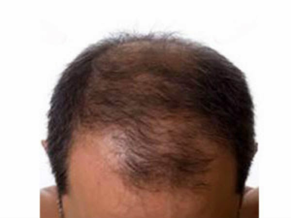 A more detailed description of baldness ~ health tips