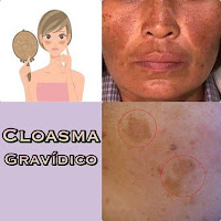 Encantadora e Sensual Estética by Helena Sanchez: MELASMA ou CLOASMA ...