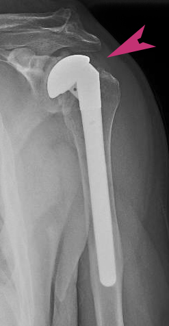UW Shoulder and Elbow Academy: The humeral component: what's in a stem?