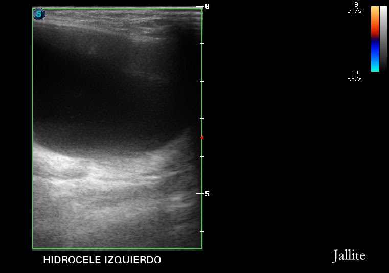 Hidrocele Bilateral y....