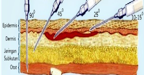 EMPAT JENIS DAN CARA INJEKSI