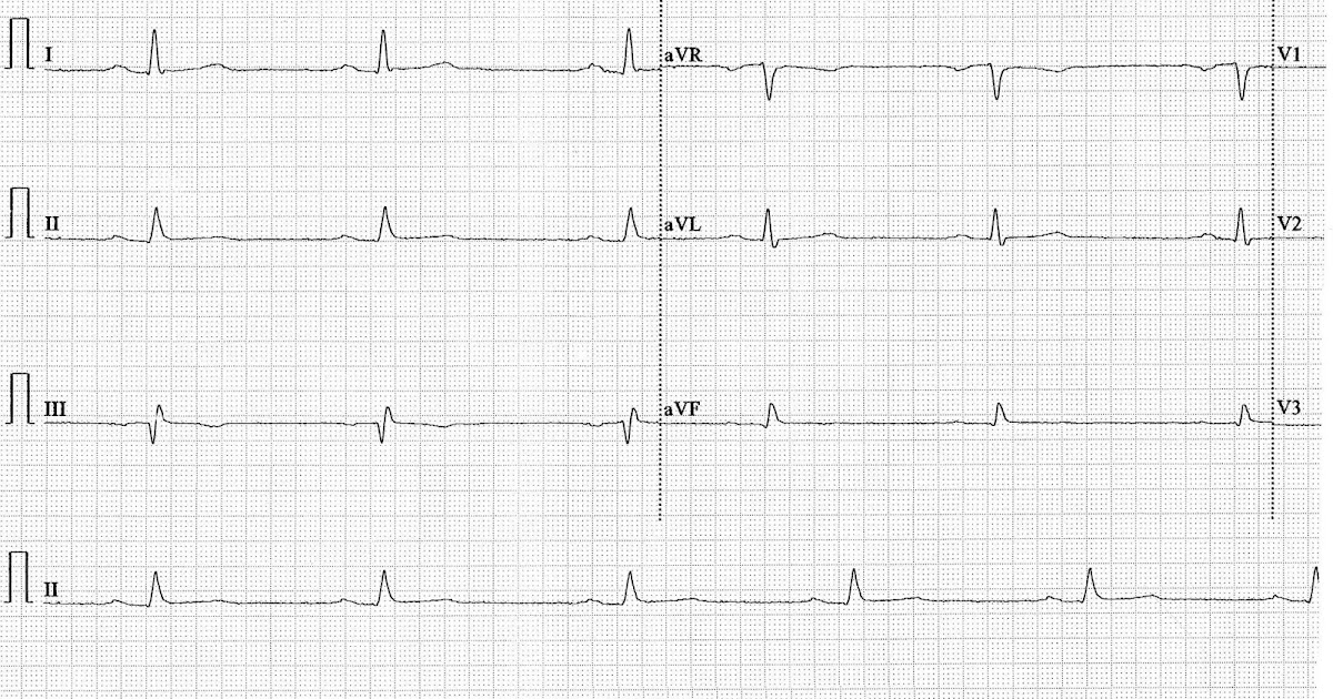 ECG of the Week: ECG of the Week - 19th November 2018 - Interpretation