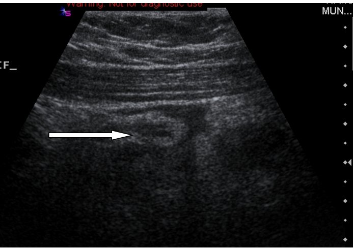 ABC Radiology Blog: Appendicitis