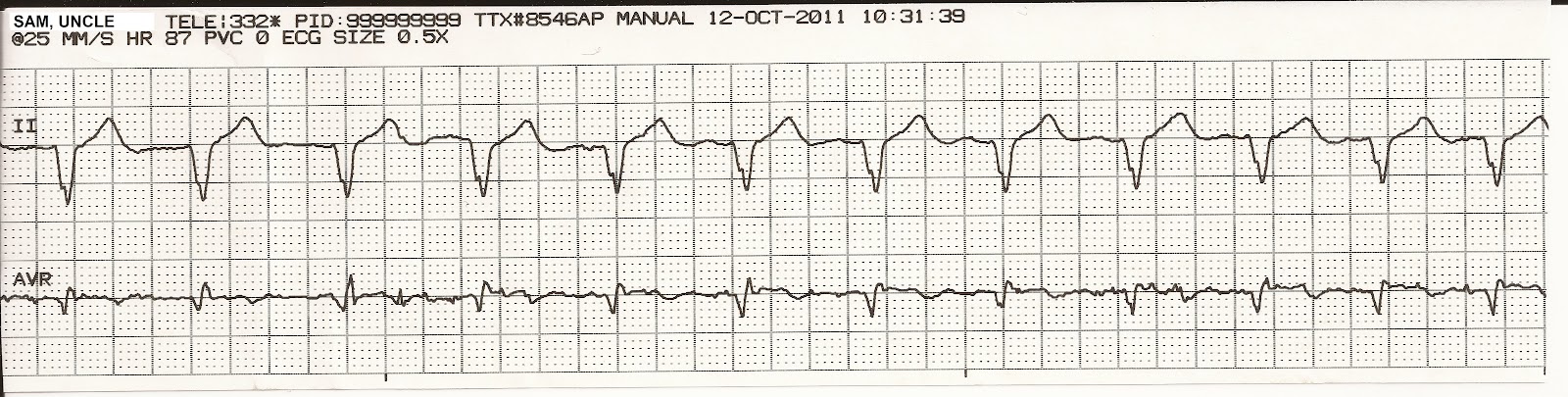 EKG Rhythm Strips 12- ventricular rhythms