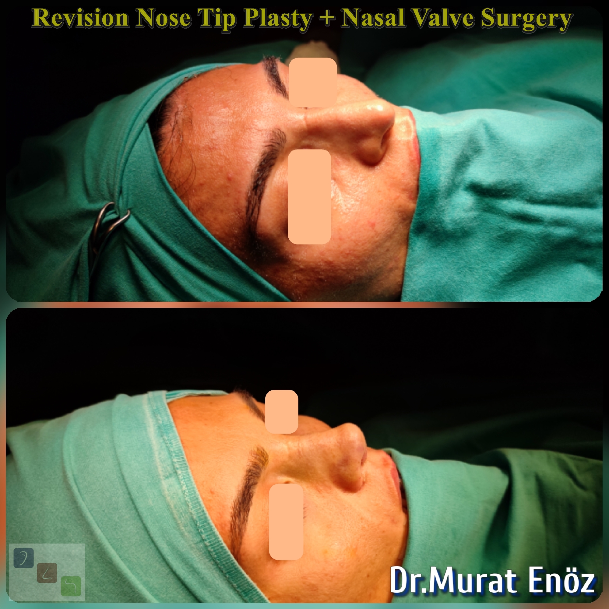 Revision Nose Tip Plasty in Istanbul