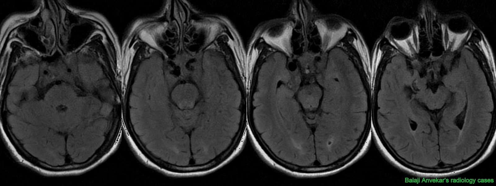 Dr Balaji Anvekar FRCR: Cerebral Mycotic Aneurysm MRI