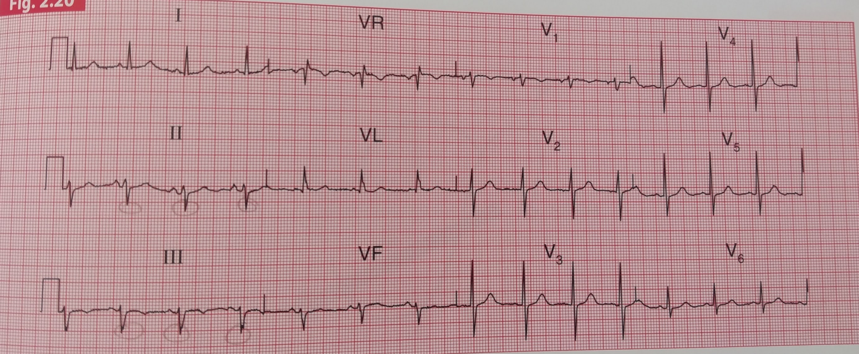 EASY WAY TO REMEMBER: LEFT AXIS AND RIGHT AXIS DEVIATION