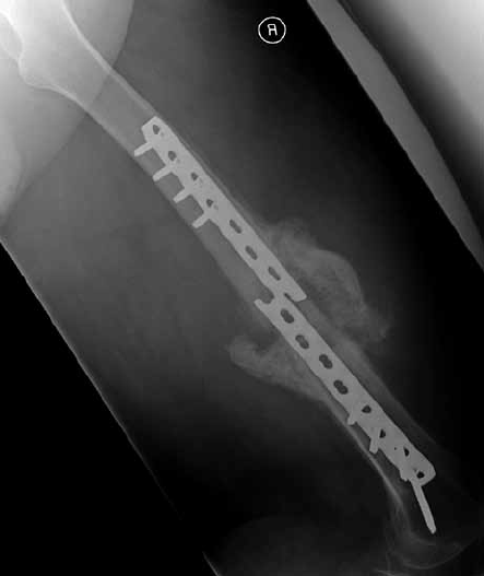 Quebra da Placa após fratura