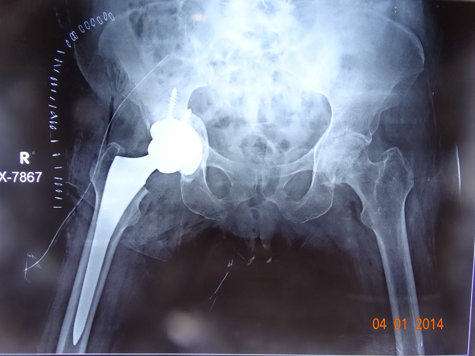 ORTHO ONE ORTHOPEDIC: Complex total hip replacement surgery in a ...