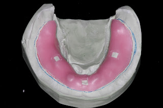Boise Idaho Prosthodontics: Edentulous Custom Tray for PVS Impression ...