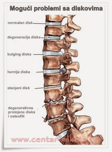 Diskus hernia: Etiologija