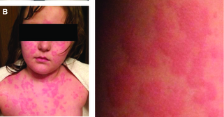 Humans and Viruses: Influenza B Causes Uncommon Rash in Canadian Outbreak