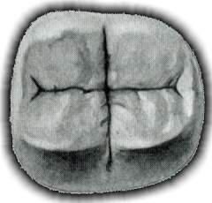 SEGUNDO MOLAR INFERIOR