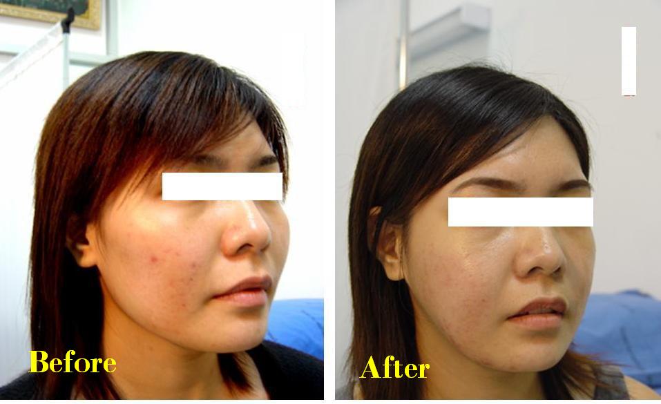 Before And After Photos Of Plastic Surgery Thailand: Cheek Bone ...