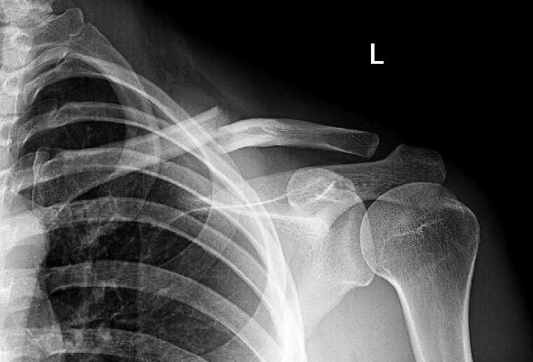 Ortopedia paso a paso: Las Fracturas mas comunes