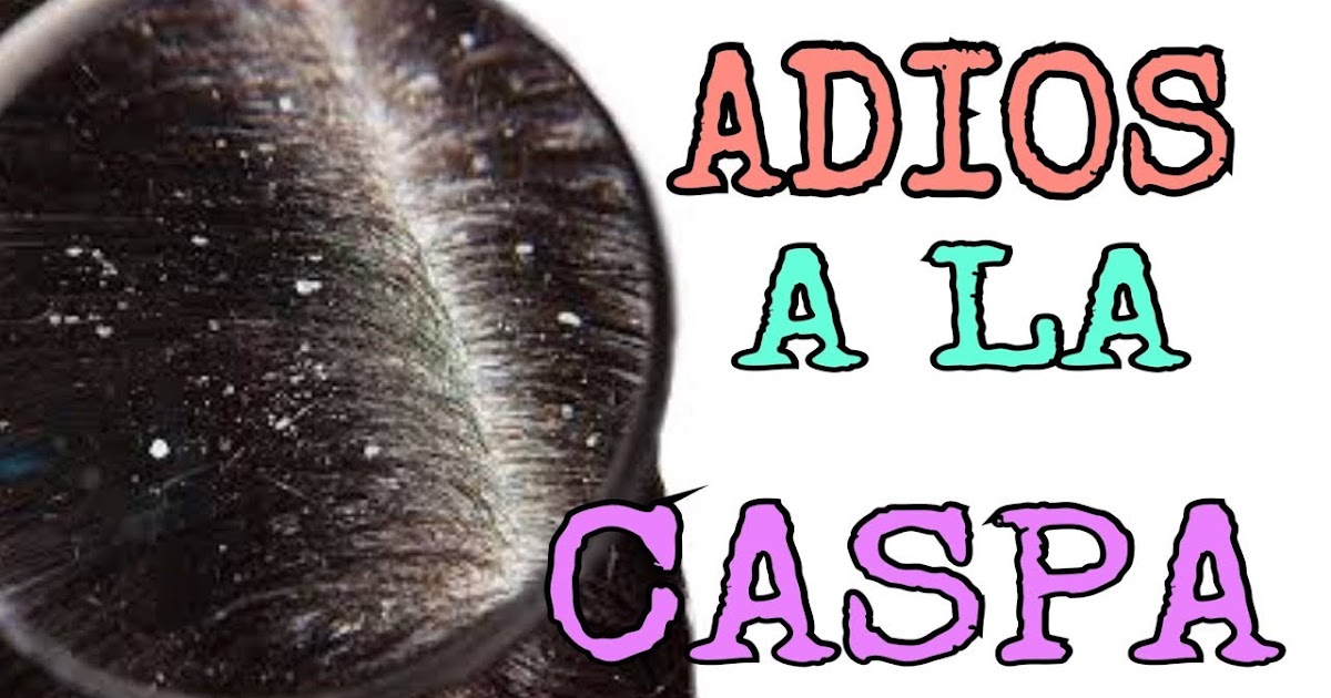 El Remedio mas Eficaz: Remedios caseros para eliminar la caspa.