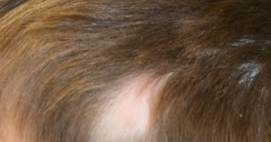 ¿Alopecia triangular temporal? Aquí las respuestas | Tratamientos Capilares