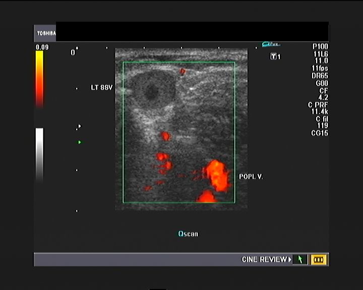 Ultrasound Imaging Interesting Venous Doppler Of Short Saphenous Vein